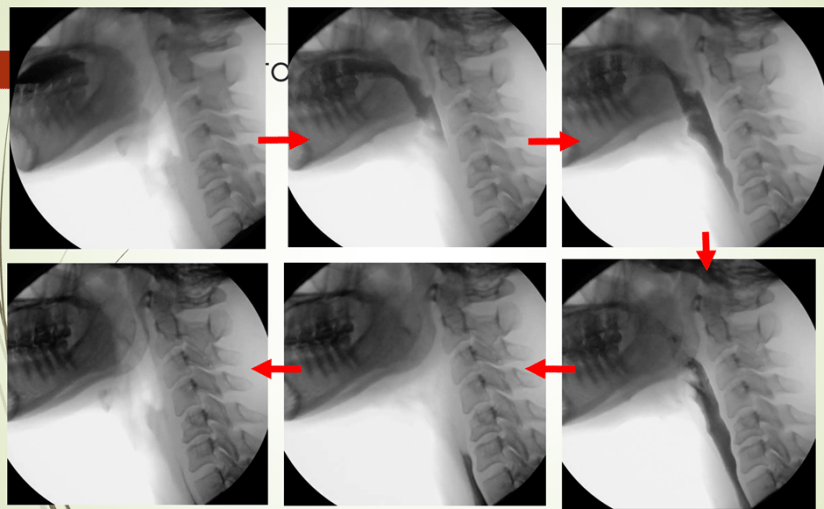 Dysphagia Therapy – Singapore Swallowing Specialists